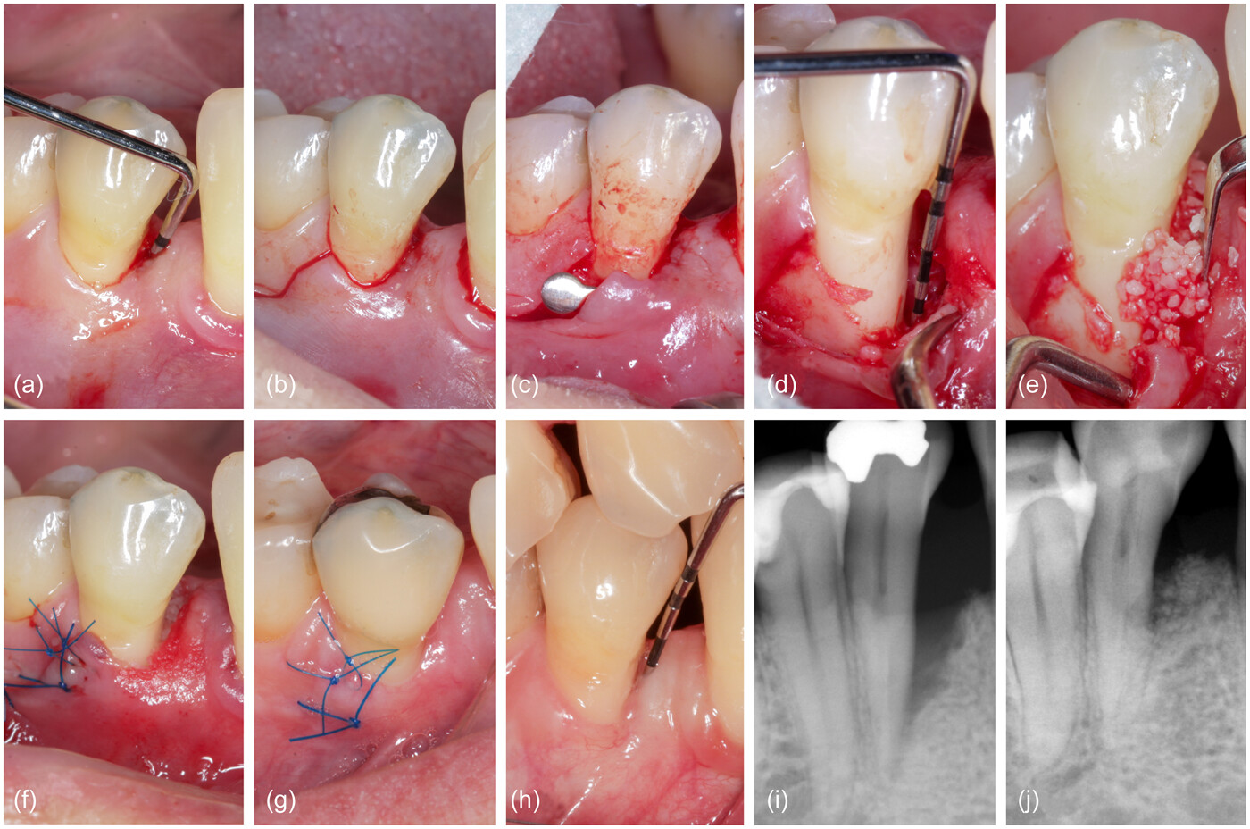 Bone gel and papillae tunnelling for isolated intrabony defects ...
